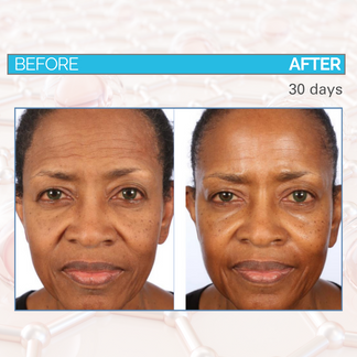 Deep Wrinkle Filler - Trace + Erase – Serious Skincare